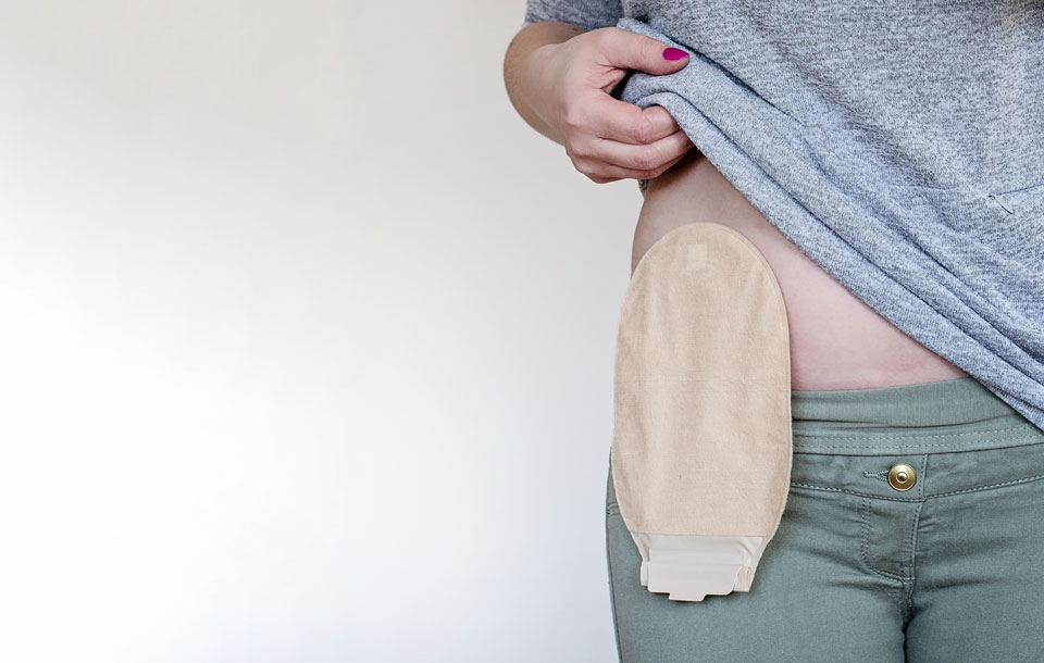 Onzeker over uw stoma | Veelvoorkomende problemen en oplossingen voor ...